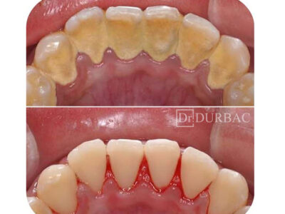 Detartraj Pret | Ghid complet despre detartrajul dentar in 2020