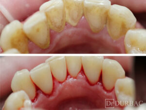 Detartraj Pret | Ghid complet despre detartrajul dentar in 2020