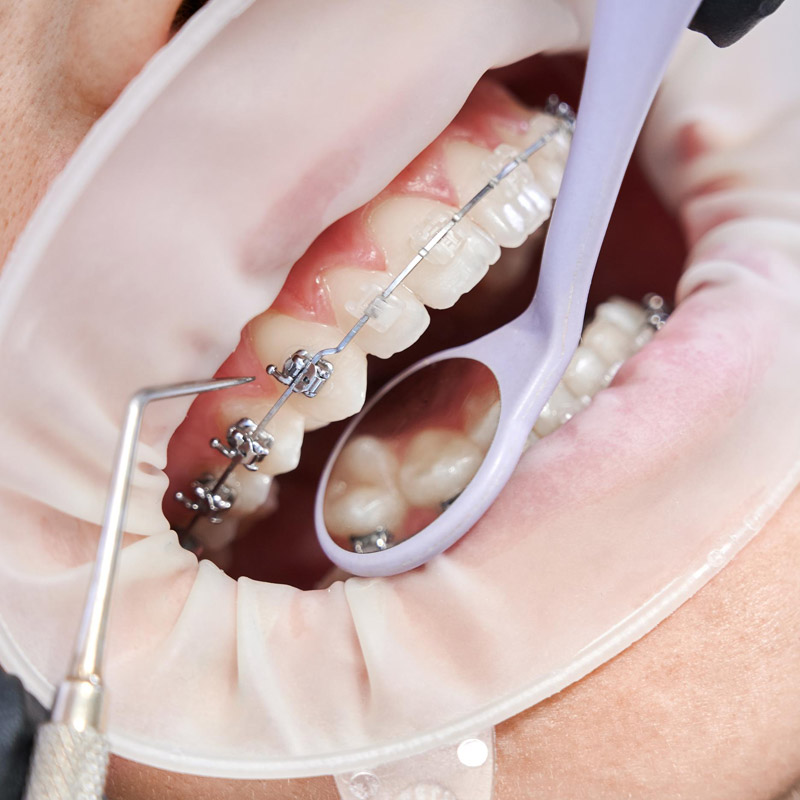 Aparat Dentar Safir - Avantaje & Pret - DELTA CLINIC DENT